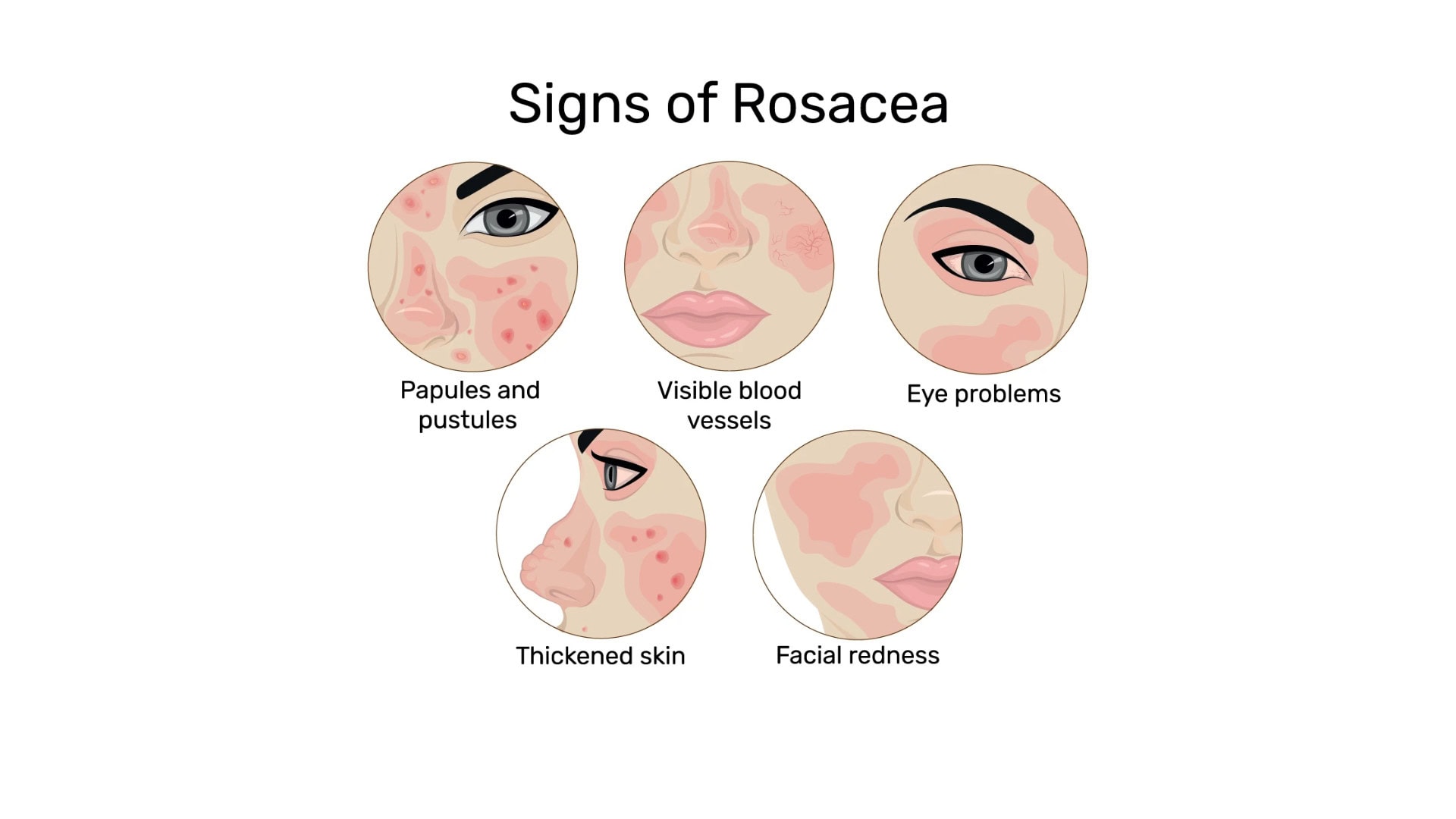 How to Identify Rosacea — Or Is It Just Redness? | Roots Guard